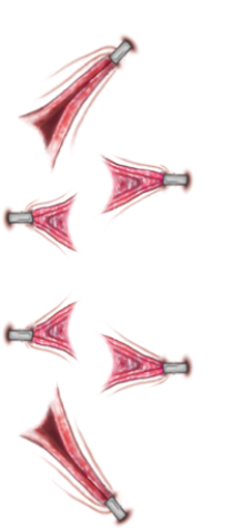 Stretched - Trauma Tattoos – Tattoo for a week